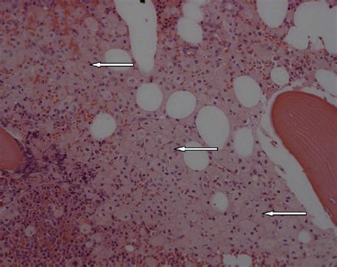 Figure 1 from Co hematolog powinien wiedzie ć o chorobie Gauchera What