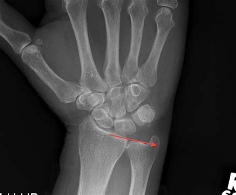 Tfcc Tears The Bone School