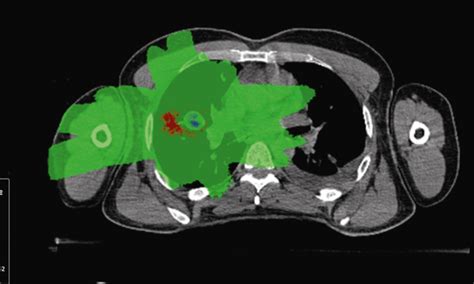 Applying Monte Carlo Accuracy With Clinical Workflow Simplicity • Healthcare In