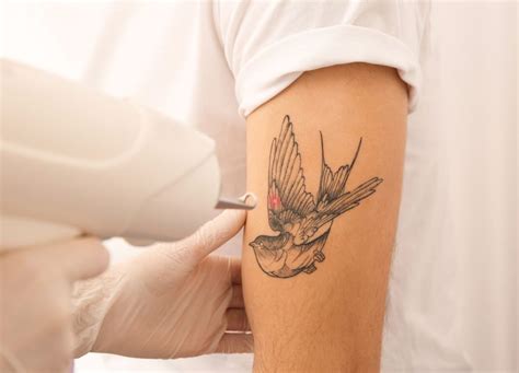Unlocking The Benefits Of Pico Laser For Tattoo Removal