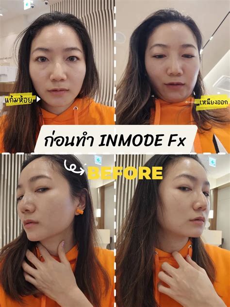 Inmode Forma Fx การค้นหาใน Lemon8