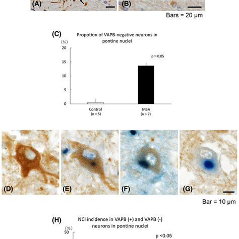 Vapb Immunoreactivity In Neuronal And Glial Inclusions In The Pontine