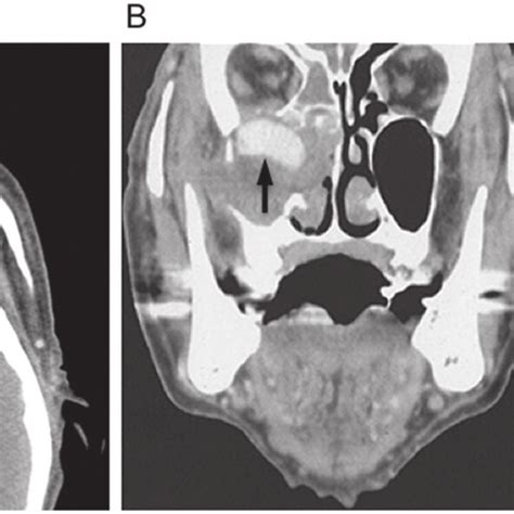 Postcontrast Ct Shows The Enhancement Of A Part Of The Mass With