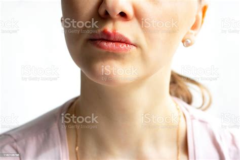 밝은 분홍색 티셔츠에 여자의 입술에 바이러스 헤르페스의 붉은 거품 하부 얼굴이 보입니다 의학 치료 가로 배너 복사 공간 흰색