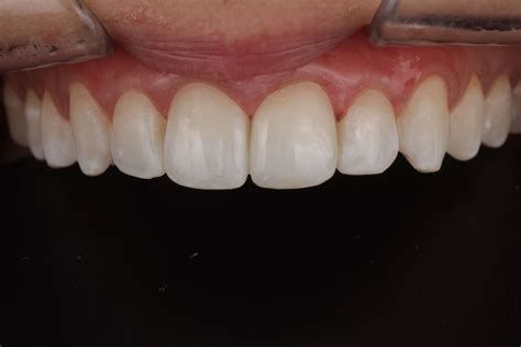 Composite Bonding Southampton Cosmetic Dentist Southampton