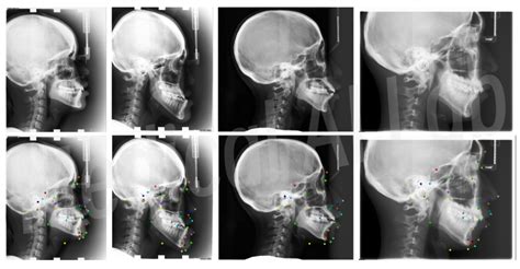 Miccai Cl Detection2023：头影x Ray图像关键点检测挑战赛 知乎