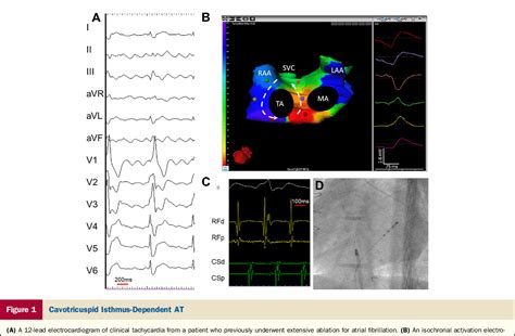 Figure 1 From Validation Of Novel 3 Dimensional Electrocardiographic Mapping Of Atrial