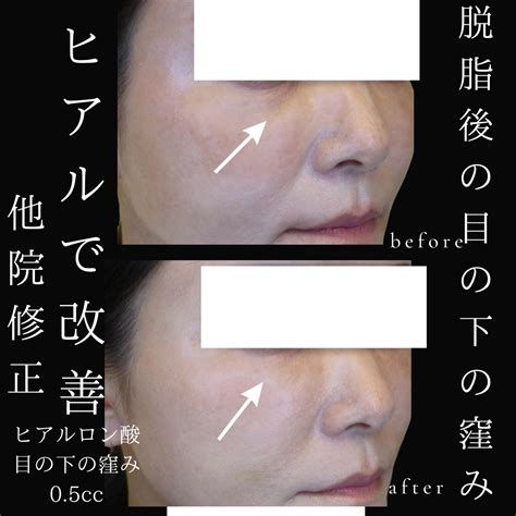 目の下の脱脂術後の窪みに対するヒアルロン酸注入治療 40代女性他院修正