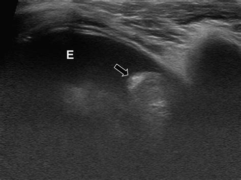 Paediatric Torsed Extralobar Sequestration Containing Calcification Imaging Findings With