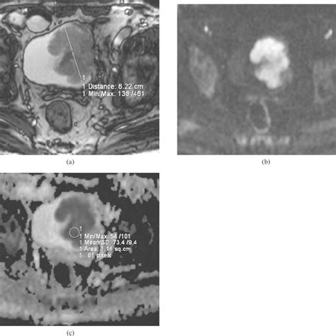 A Axial T 2 Weighted Mr Image Of A 76 Year Old Man Depicting A 7 Cm