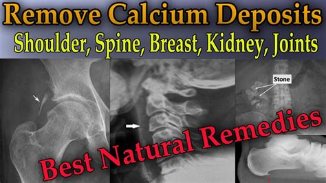 How Do You Get Rid Of Calcium Deposits In Your Joints At Ruth Flaherty Blog
