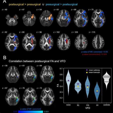 Tract Based Spatial Statistics Results A Comparison Of Fractional