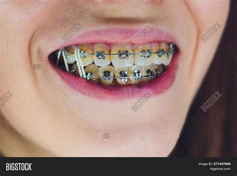 Teeth Dental Braces Image Photo Free Trial Bigstock