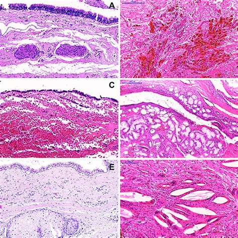 Histopathological Features Of The Epithelial Lining Of Nasopalatine