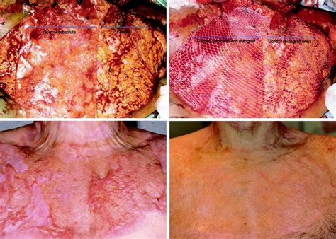Dermal Substitution In Acute Burns And Reconstructive Surger