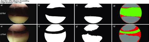Otsu Algorithm Top Row L3 A Frame 2 Of L3 Arthroscope Video B L3