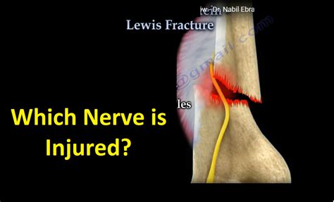 Holstein Lewis Fracture —