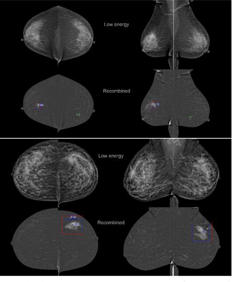 Figure 3 From Ai Based Cancer Detection Model For Contrast Enhanced