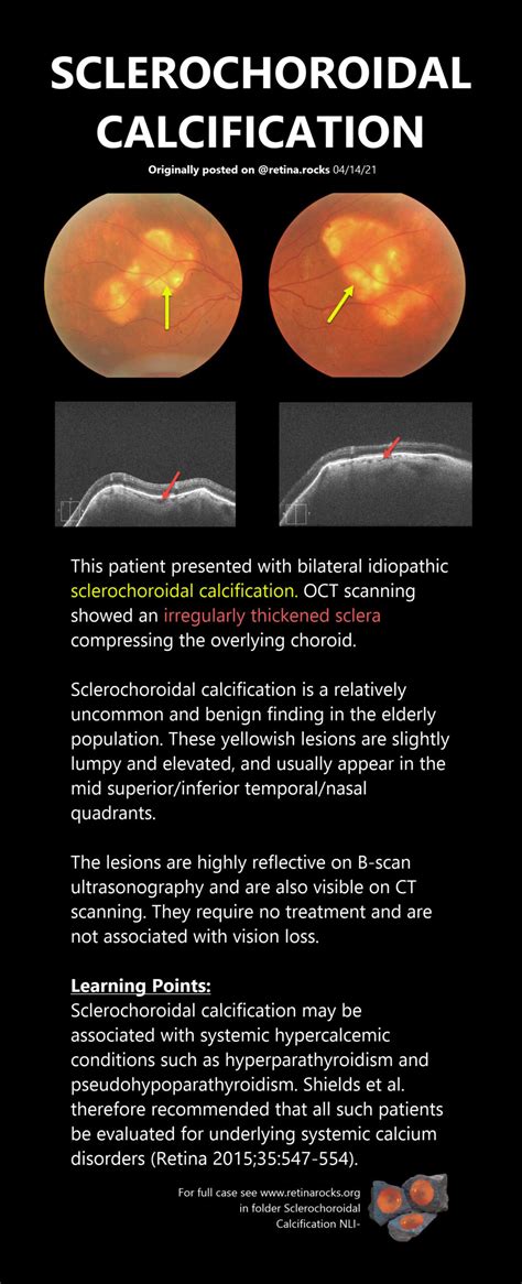 Neoplastic Choroid Disorders Sclerochoroidal Calcification Retina Rocks