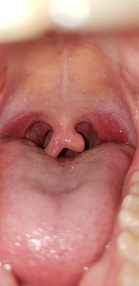 I Have A Double Uvula R Mildlyinteresting