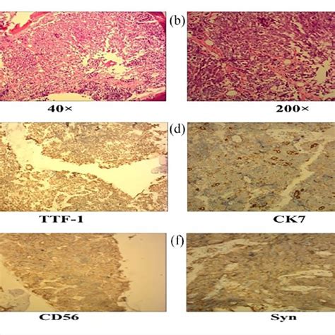 Histopathology Of Bone Marrow Biopsy Histopathology Of Bone Marrow