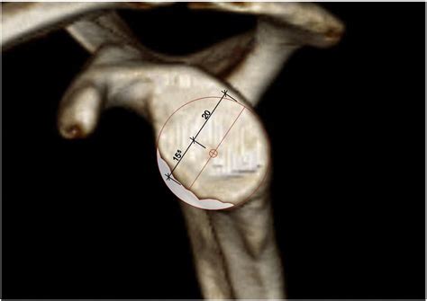 An Alternative Technique For The Exact Sizing Of Glenoid Bone Defects