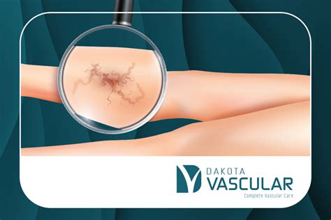 Can Sclerotherpay Help With Your Varicose Veins Blog