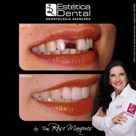Sorriso renovado implante dentário unitário Agende uma