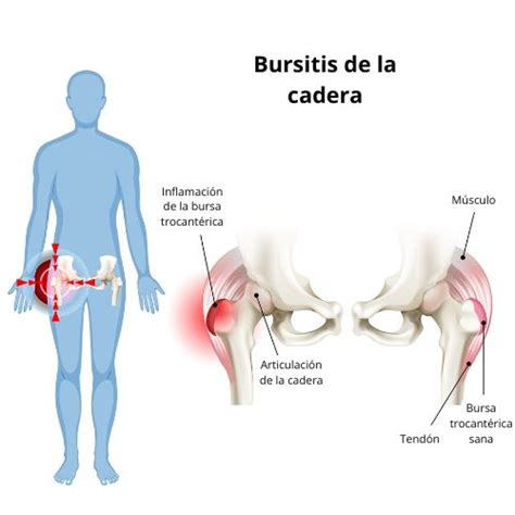 Bursitis Trocantérea Síntomas Y Tratamiento Con Terapia Celular Blog