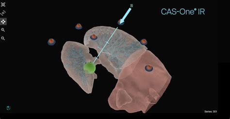 Cascination On Linkedin The March Top Case An Osteosarcoma Metastasis