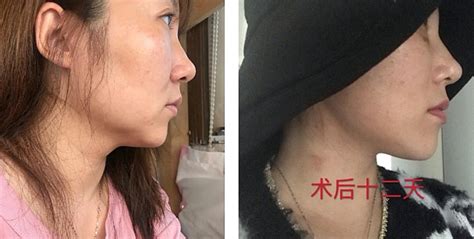 拉皮手术的风险和后遗症，拉皮手术可以维持多久 哔哩哔哩