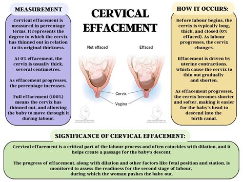 Integrated Maternity On Linkedin Cervical Effacement Also Known As