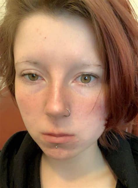 Ptosis R Plasticsurgery