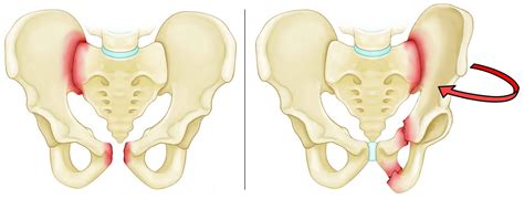 Pelvic Fracture Types Causes Signs Symptoms Diagnosis And Treatment