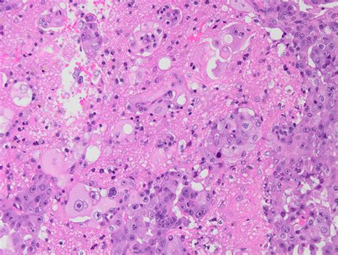 Brain Metastasis Lung Adenocarcinoma 3d Atlas Of Neurological Surgery