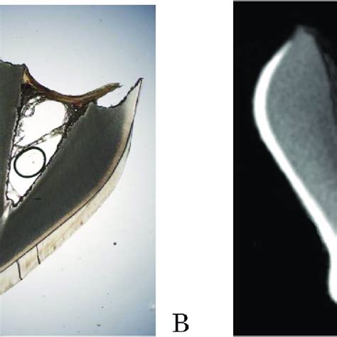 E Controled Intact Tooth Upper Left Primary Central Incisor Of Case