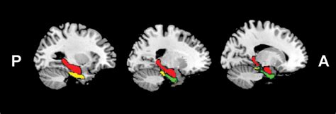 Regions Of Interests Unilateral Red Hippocampus Green Entorhinal Download Scientific