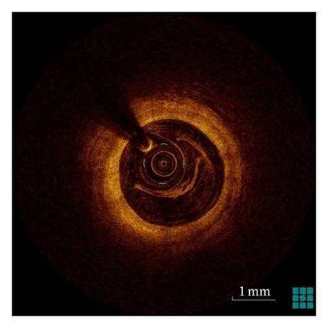 A Shows A Cross Sectional Ivus Image With Visible Calcification And Download Scientific