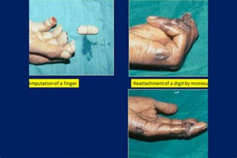 Injury And Finger Amputation Case Study Dr Jindal