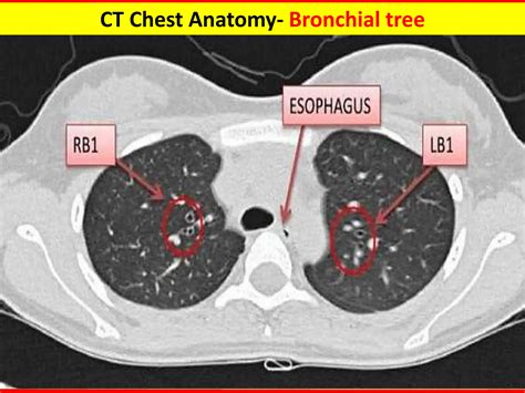 Computed Tomography Chest Fundamentals Update Ppt