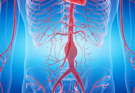 Aneurizma Abdominalne Aorte Uzroci Simptomi Liječenje