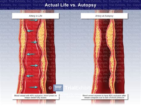 Actual Life Vs Autopsy Trialquest Inc
