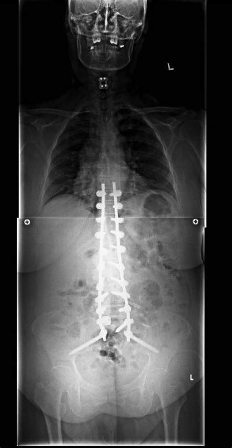 Case Example 1 Postoperative Ap X Ray Download Scientific Diagram