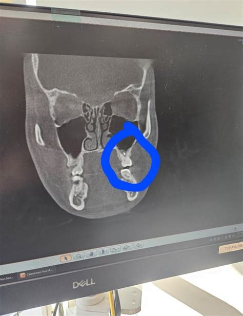 Left Maxillary Sinus Wall Inflamed Rradiology