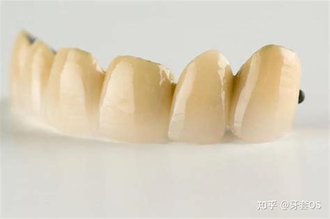 科普 烤瓷牙崩瓷怎么办 知乎