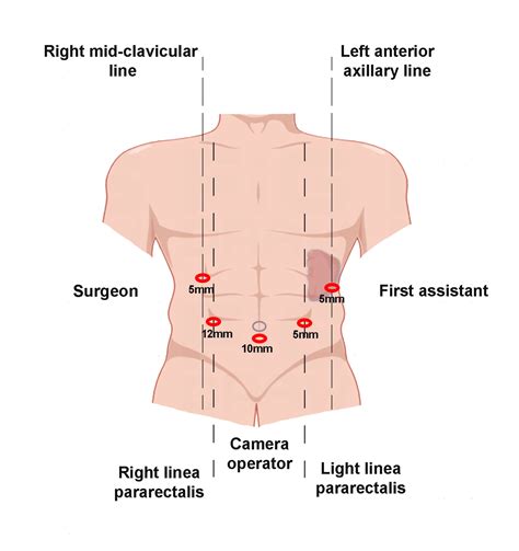 Application Of Microwave Ablation In Laparoscopic Partial Splenectomy