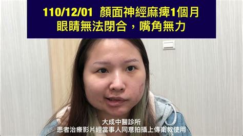 顏面神經麻痺，針灸78次表情自然，笑容甜美，美麗無價！ Youtube