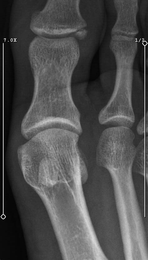 Broken Toe R Askdoctorsmeeee
