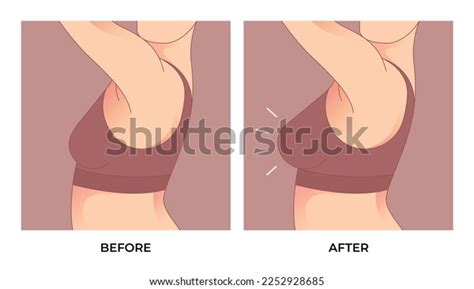 Female Breasts Bra Before After Augmentation Stock Vector Royalty Free