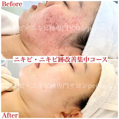 千葉ニキビ・ニキビ跡専門サロン【メニューand料金】 千葉県船橋市 ニキビ・ニキビ跡の悩みを解決。ダウンタイムなしの大人ニキビ専門のサロン